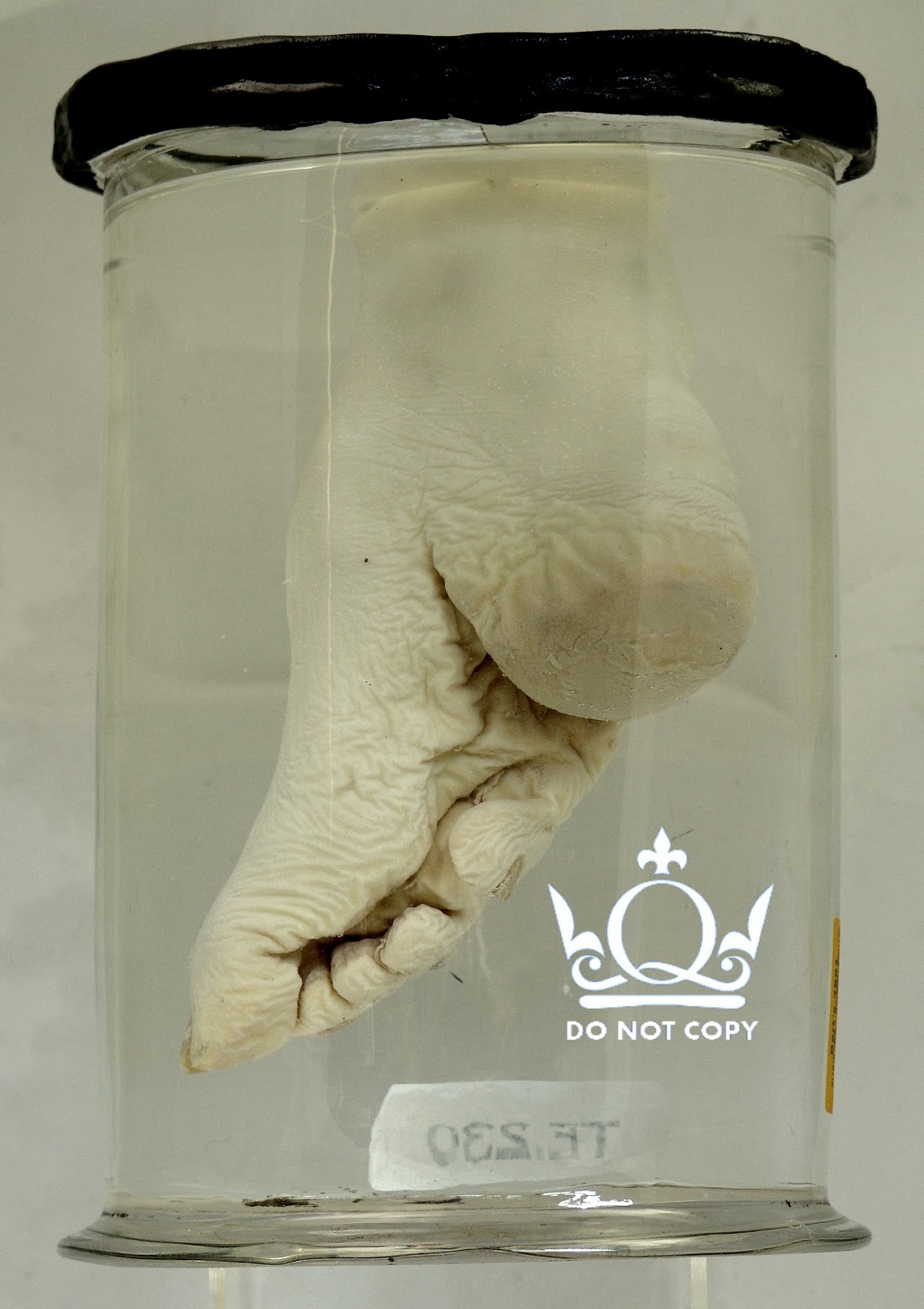 Barts Pathology Museum: Specimen TE.230 - From the Archives