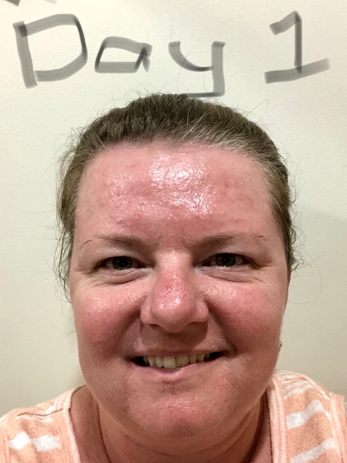 Efudix Treatment November 2018