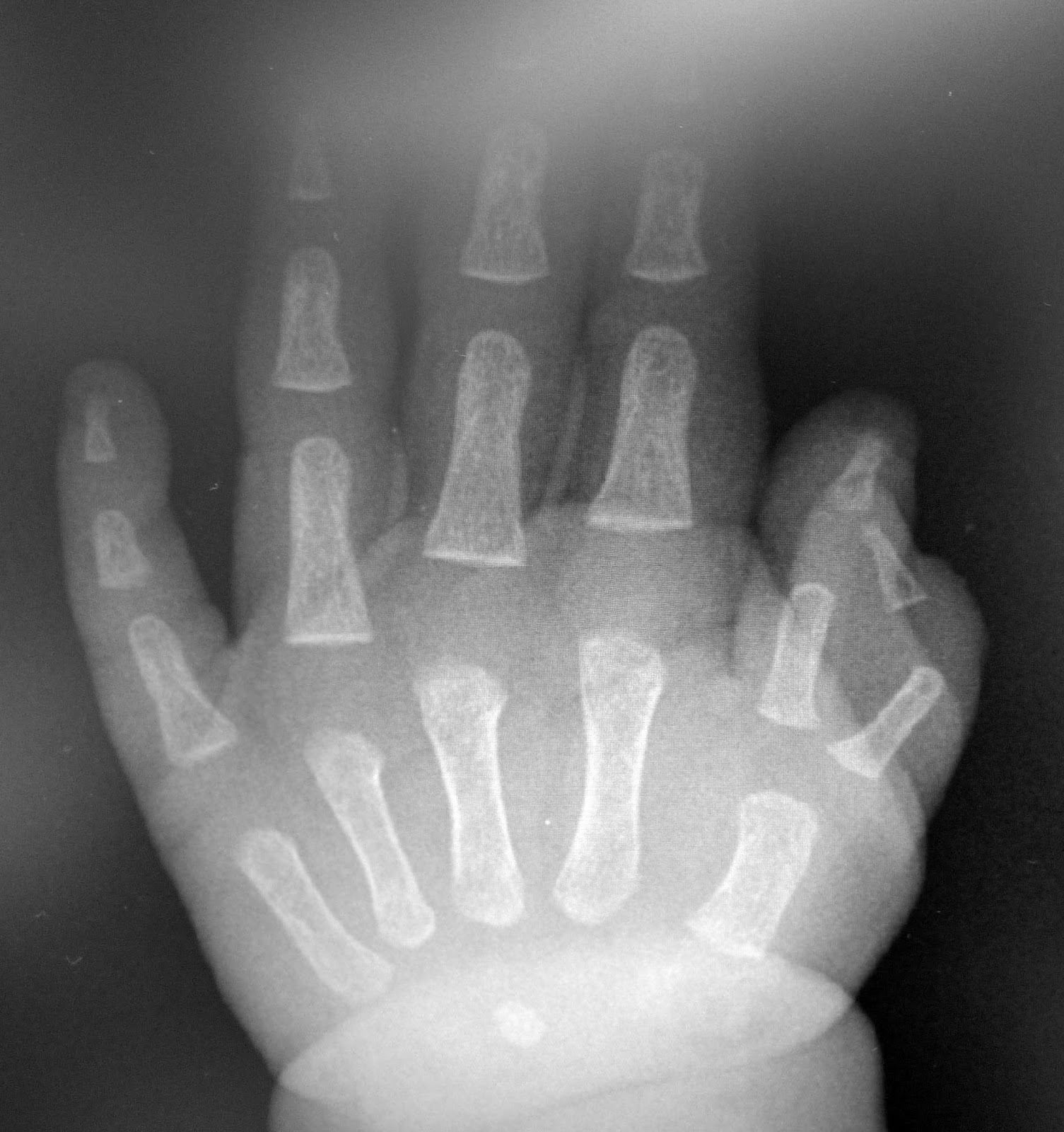 Extra Thumb | Congenital Hand and Arm Differences | Washington ...