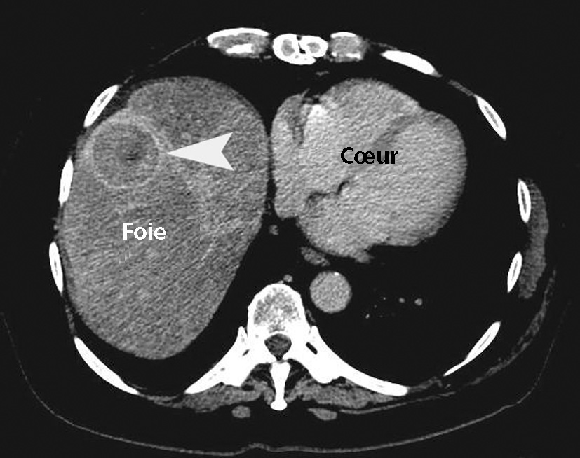 hépato-gastro-entérologie : cancer du foie