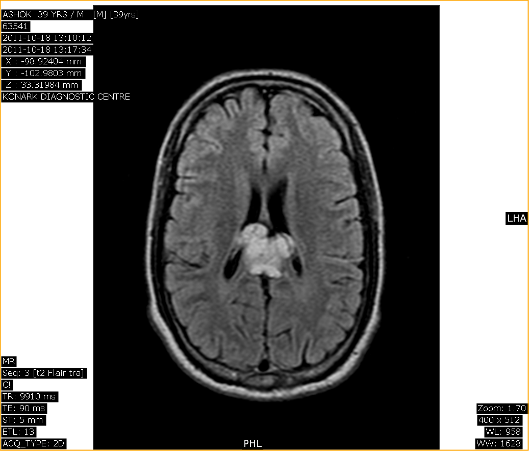 drvcsradiodiagnosis: corpus callosal lipoma- case report