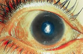 Buta Senja ~ Panduan Praktik Klinis Bagi Dokter