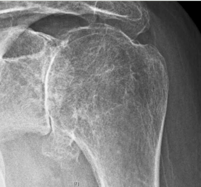 UW Shoulder and Elbow Academy: Fixed posterior subluxation - management ...