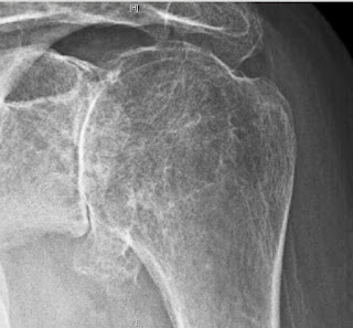 UW Shoulder and Elbow Academy: Fixed posterior subluxation - management ...