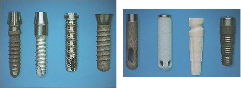 SevaDharma Dental Clinic: Dental Implant - Indications & Contraindications