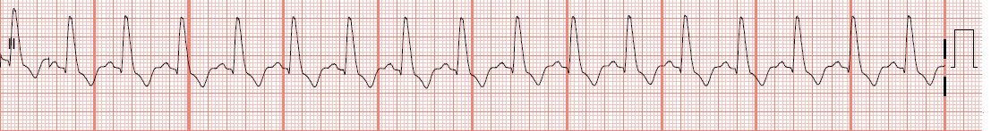 EKG Rhythm Strips 09