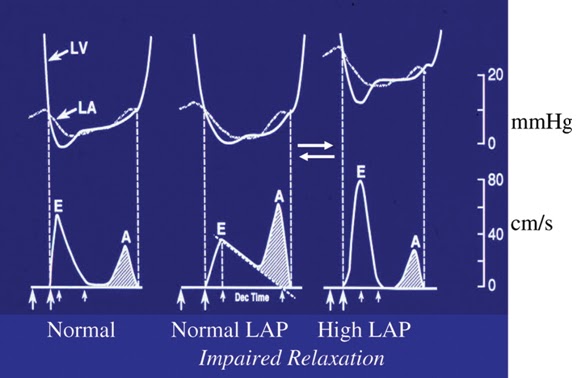 ASE Guidelines for the Evaluation of Left Ventricular Diastolic Function