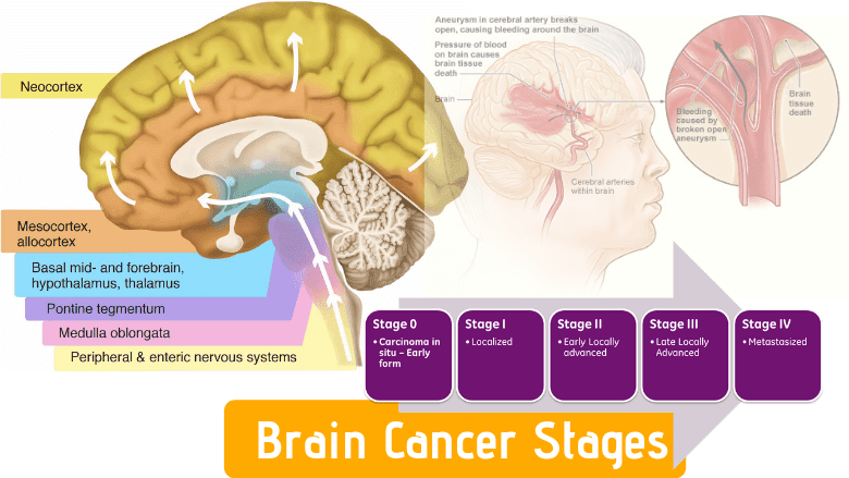 How Many Stages Does Brain Cancer Have - CancerWalls