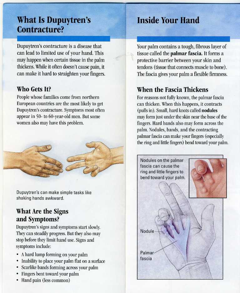 MARIETTE'S BACK TO BASICS: {My Hand and Dupuytren's Contracture}