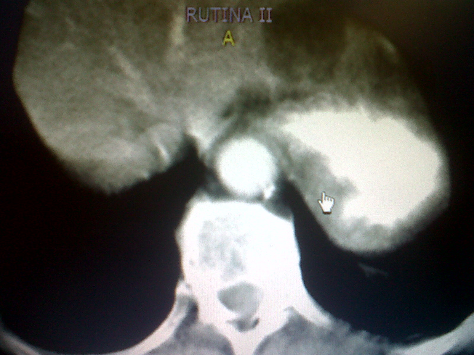 Endoscopia y Cirugía Digestiva: PACIENTE CON DISFAGIA Y LESION ...