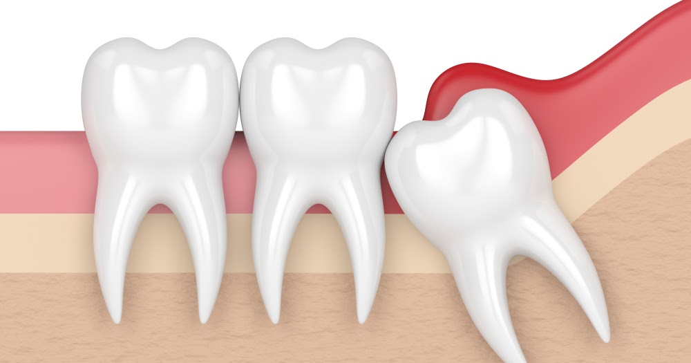 Tooth Impaction - Overview, Causes, Prevention, And Treatment