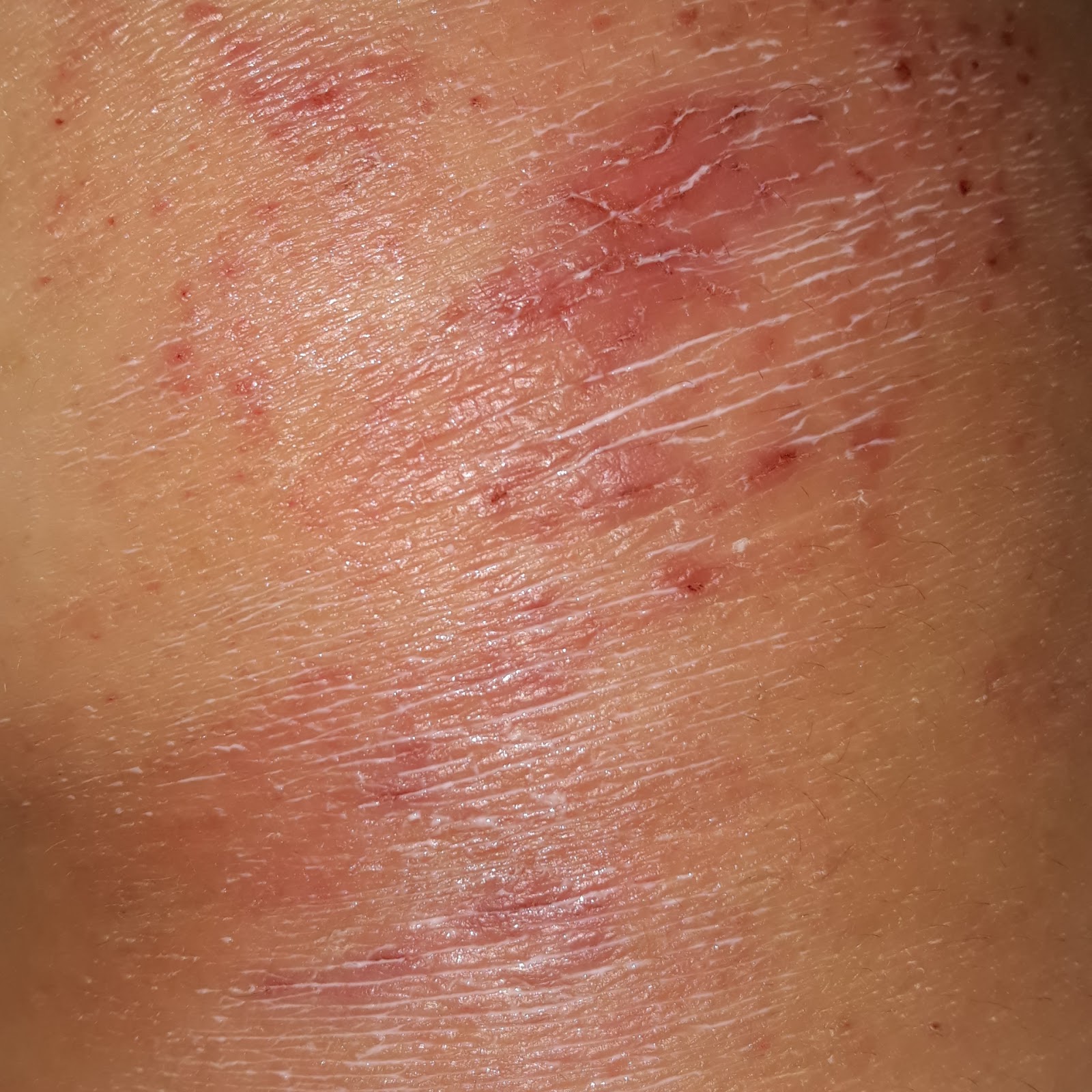 Dermatite atópica | Sampa com Crianças