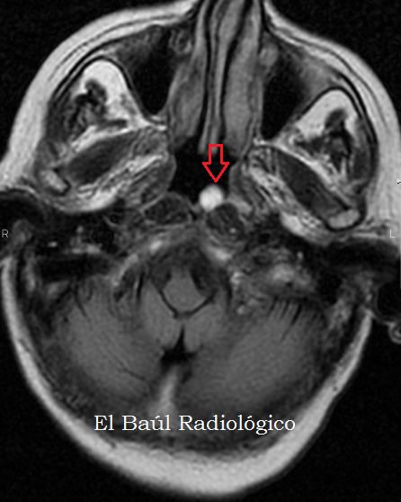 El Baúl Radiológico: QUISTE DE TORNWALDT. BURSA RINOFARÍNGEA (Tornwaldt ...