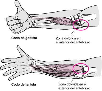 EPITROCLEITIS - EPICONDILITIS ~ SANASTUSALUD