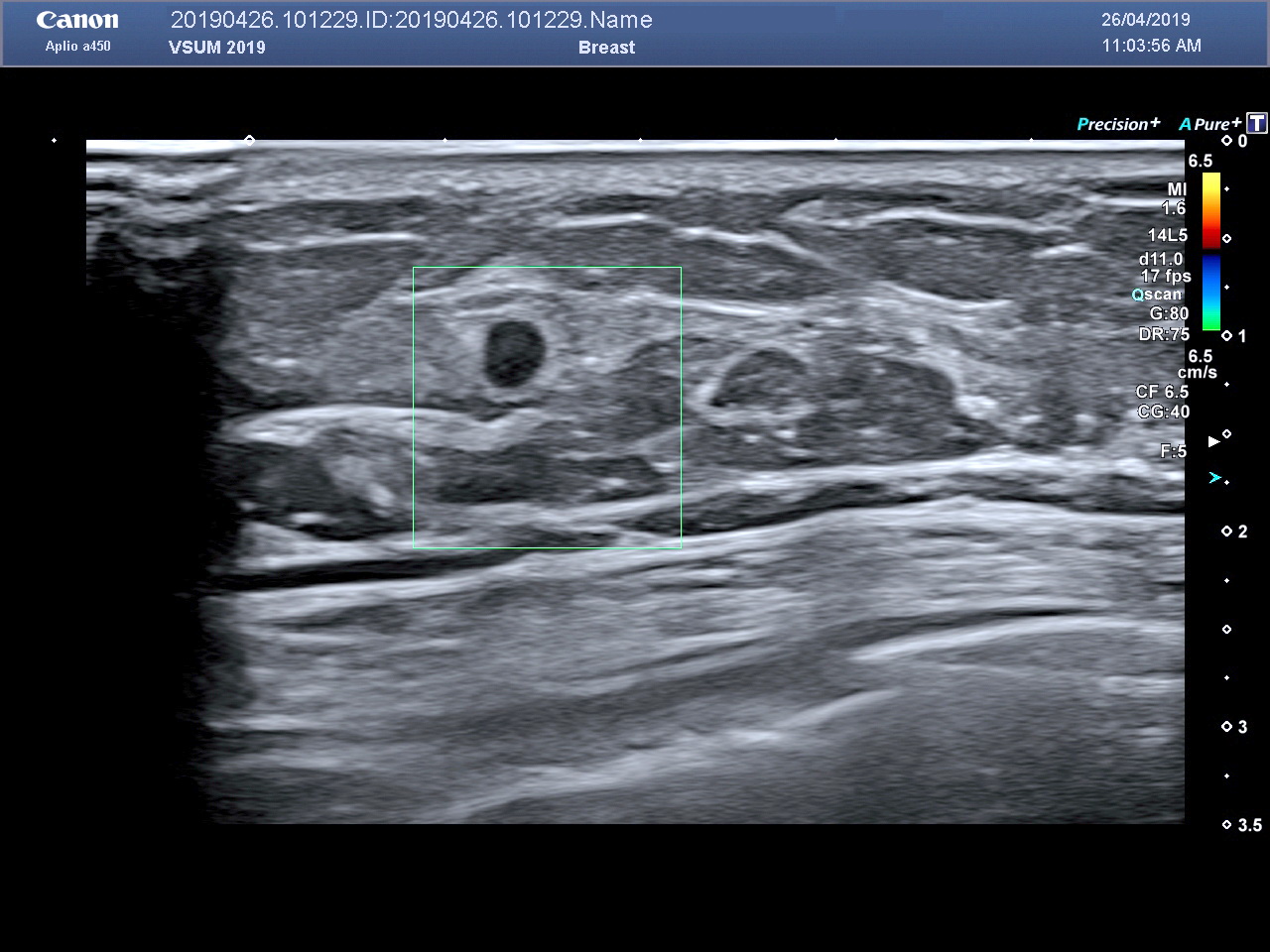 VIETNAMESE MEDIC ULTRASOUND: CASE 547: MONDOR'S DISEASE, Dr PHAN THANH ...