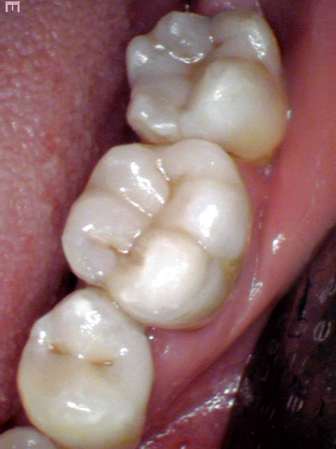 Creation - The Written Truth: WISDOM TEETH, Pech de l’Aze, DR. CUOZZO ...