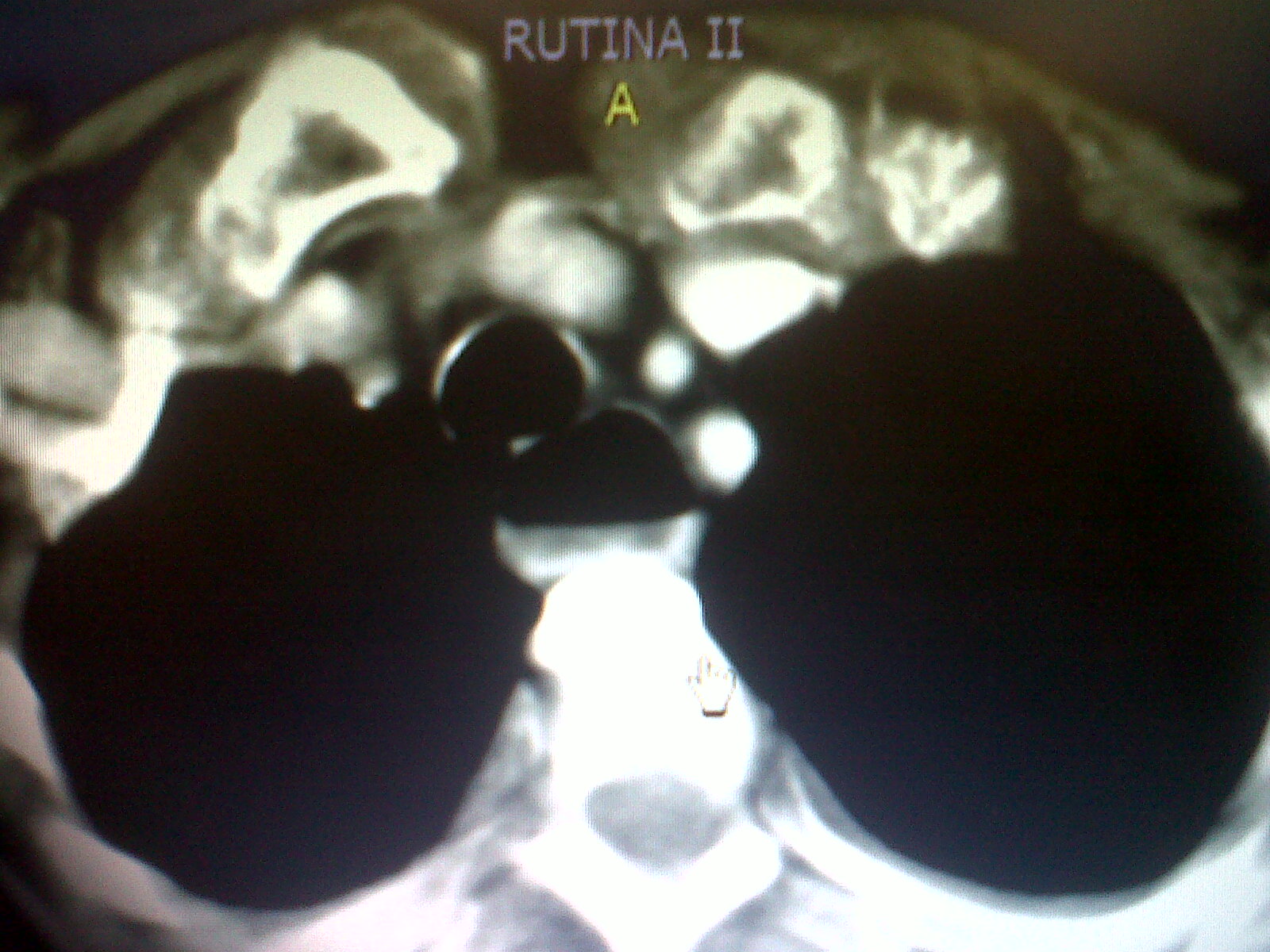 Endoscopia y Cirugía Digestiva: PACIENTE CON DISFAGIA Y LESION ...