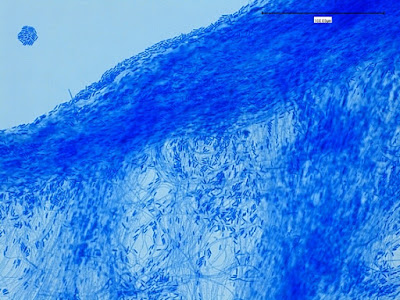 Fun With Microbiology (What's Buggin' You?): Sarocladium kiliense
