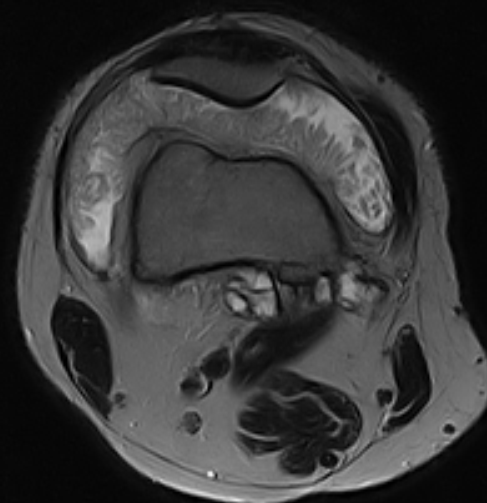 Lipoma arborescens-MRI - Sumer's Radiology Blog