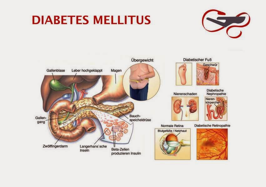 Diabetes Mellitus Tipo 2: Definición de la Diabetes Mellitus