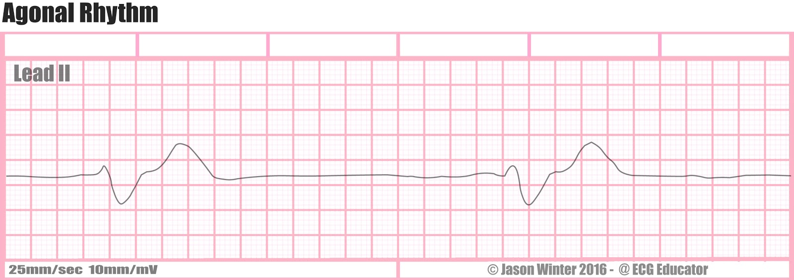ECG Educator Blog : Six Second ECG Rhythm Strips
