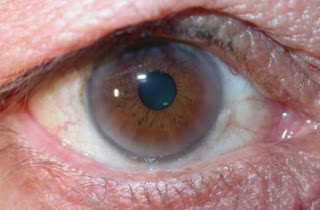 Neuronas enlatadas: ¿Qué es eso? El arco senil