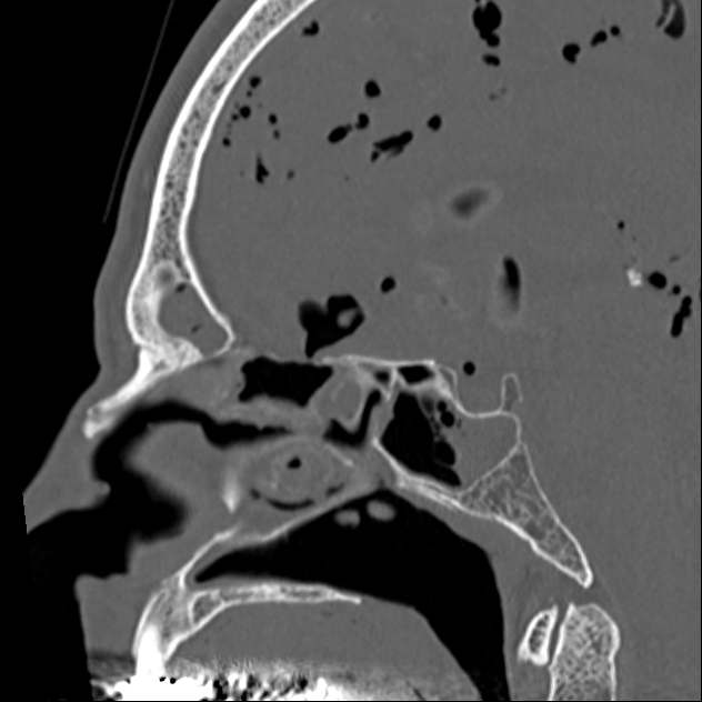 JKSIOWMD: HOW TO PERFORM SAFE FESS AND AVOID COMPLICATIONS