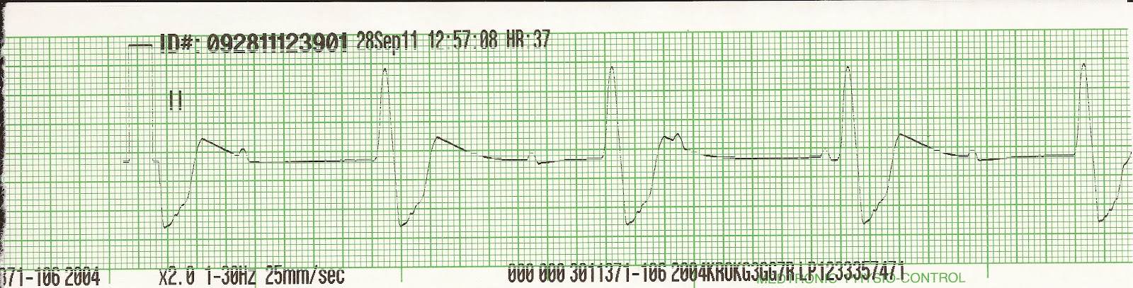 EKG Rhythm Strips 13- Heart Blocks
