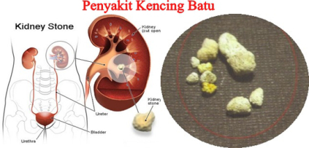 Obat Kencing Batu Tradisional
