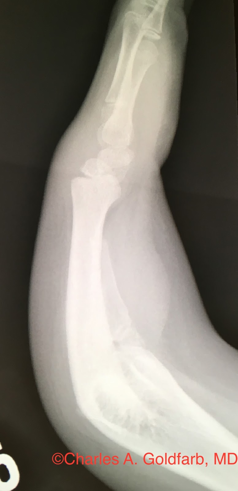 Ulnar Deficiency Follow Up | Congenital Hand and Arm Differences ...