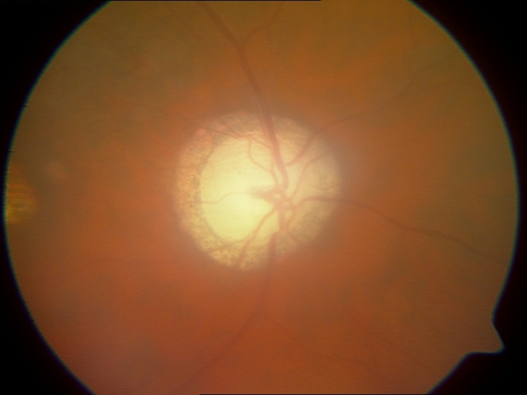 Glaucoma: The Sneak thief of sight: Peripapillary halo and atrophy in ...
