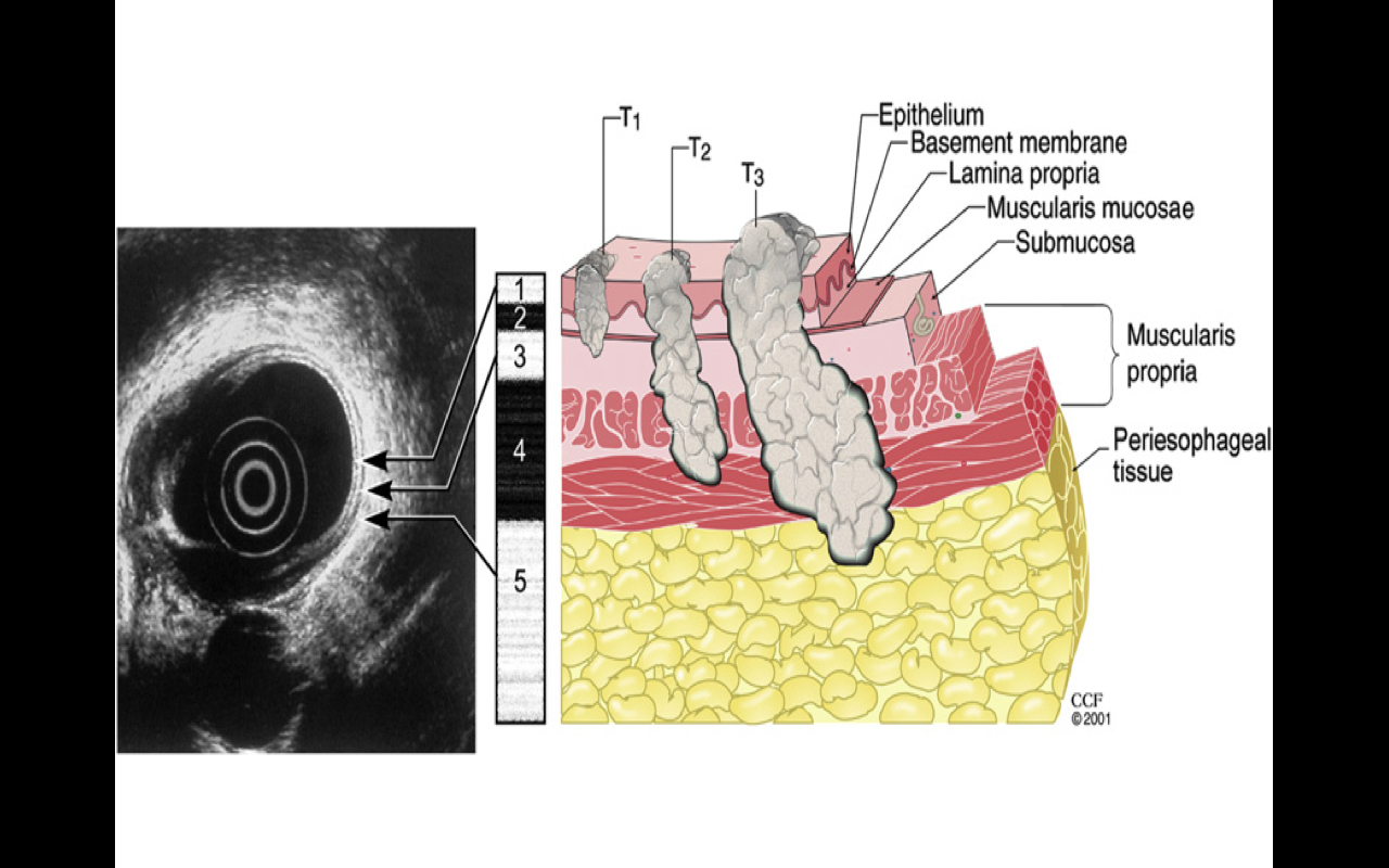 Patología de Esófago: ADENOCARCINOMA DEL TERCIO DISTAL DEL ESOFAGO ...