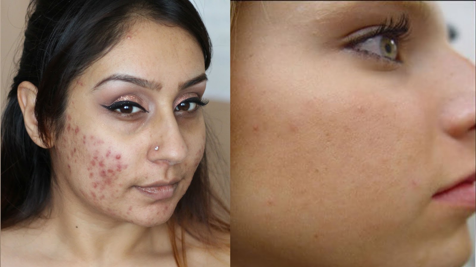 How To Care Acne Prone Skin Skin Acne