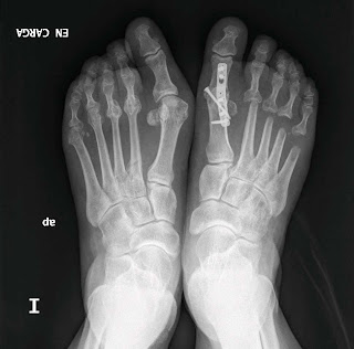 Fanáticos del pie: ATLAS DE PATOLOGIA DEL PIE: ANTEPIE REUMATICO