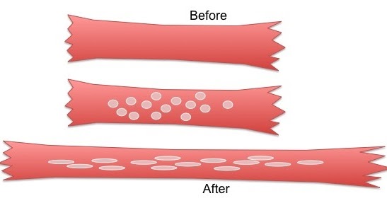 Run fast ... fall down: Iliotibial band lengthening surgery recovery