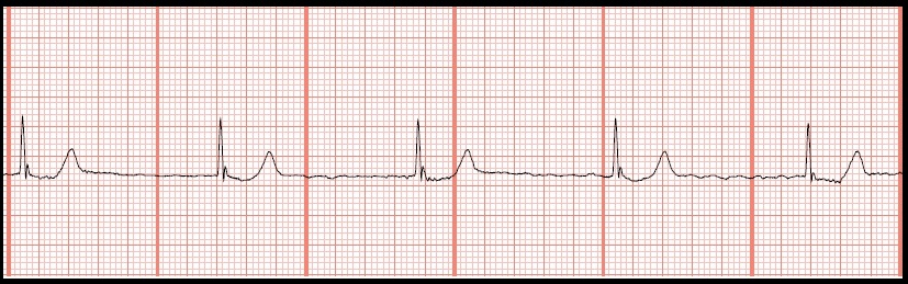 Float Nurse: Practice EKG Rhythm Strips 120