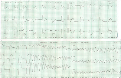 Cardiologia Intensiva: Fibrilação ventricular durante o ECG