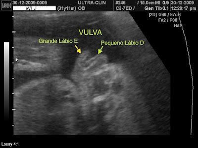 ULTRASSONOGRAFIA - Dr. Walter Lustosa Jr.: GENITÁLIA FEMININA FETAL