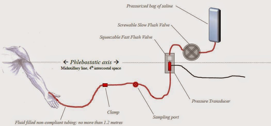 Catetere arterioso - radiale (Capitolo 12.1.1) | Manuali di Medicina ...