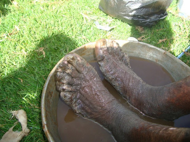 Amazing Are-Ban: Chigoe Flea or Jigger