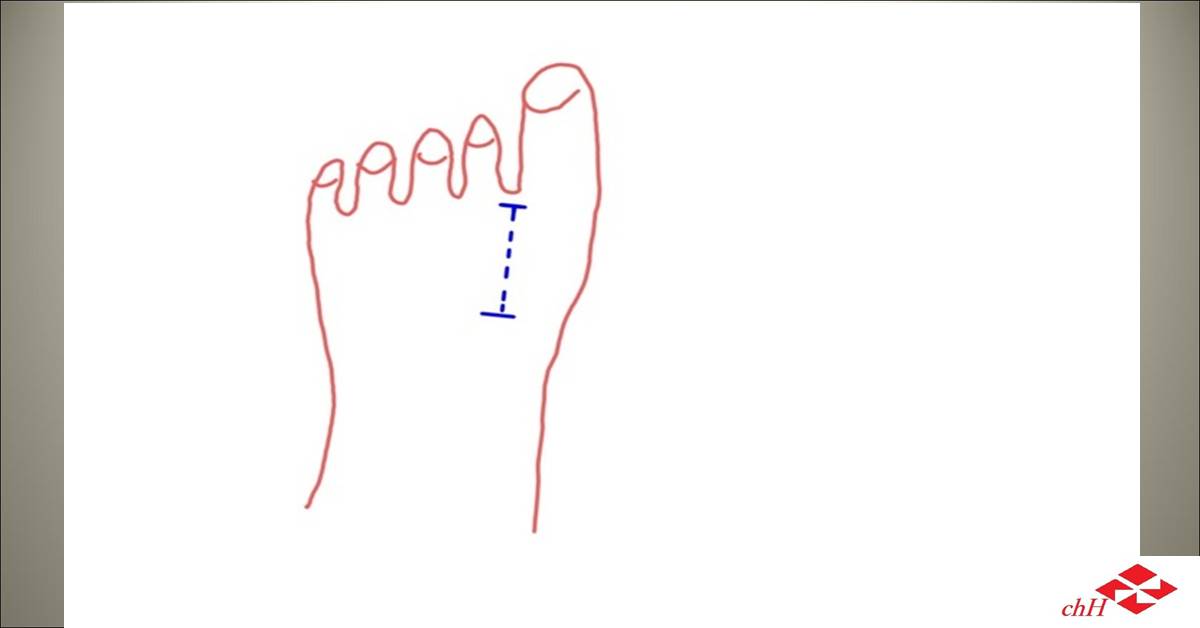 骨科醫師 謝醇樺: 腳姆趾外翻：軟組織矯正手術 modified McBride procedure