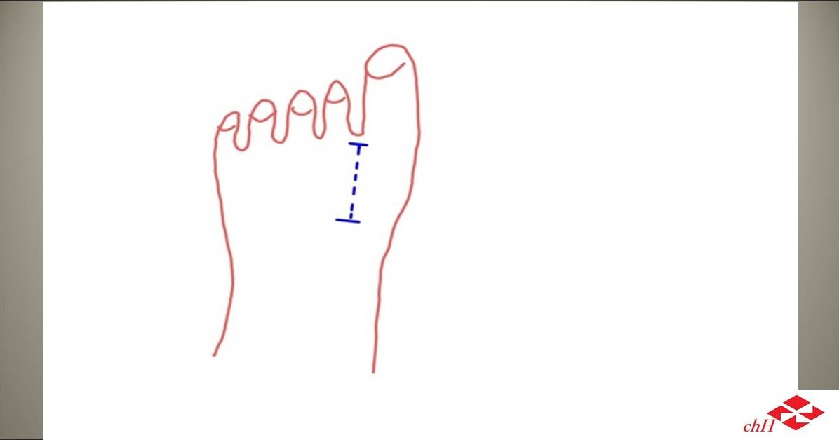骨科醫師 謝醇樺: 腳姆趾外翻：軟組織矯正手術 modified McBride procedure