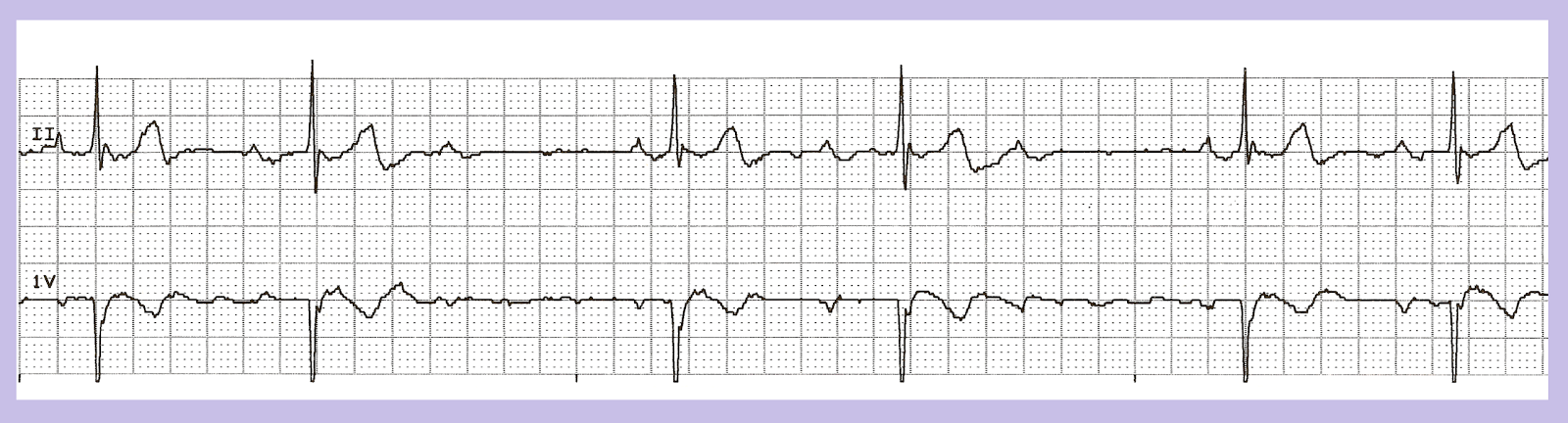 Various 2nd Degree Heart Block Type I