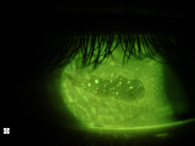 Sonoran Desert Eye Center: BITOT'S SPOT