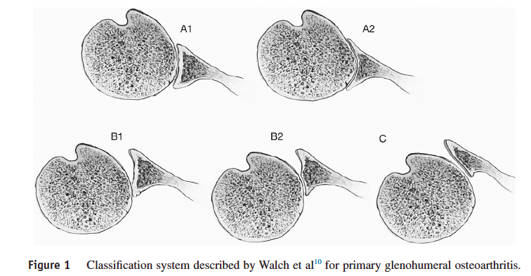 UW Shoulder and Elbow Academy: Imaging the arthritic glenoid