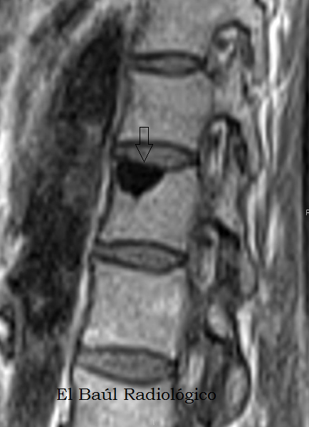 El Baúl Radiológico: ENOSTOSIS: ISLOTE ÓSEO (Bone Island: CT and MRI ...