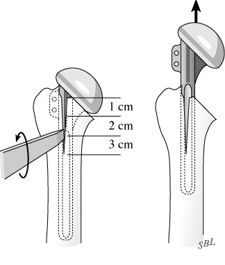 UW Shoulder and Elbow Academy: Revision surgery for failed shoulder ...