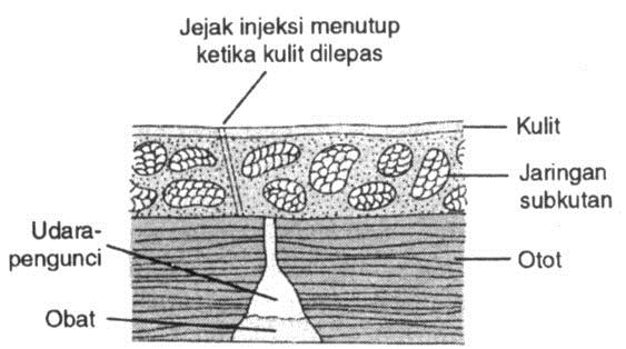 SOP Injeksi Intramuscular (IM) ~ Ns. RIO CRISTIANTO