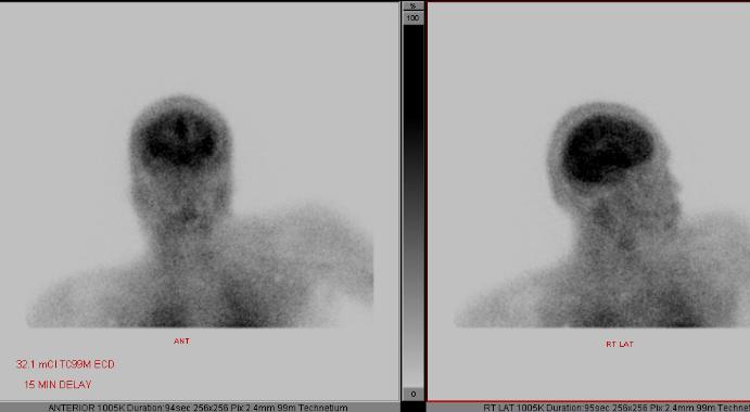 The Orange Jeep Dad...blog.: Using Nuclear Medicine to Determine Brain ...