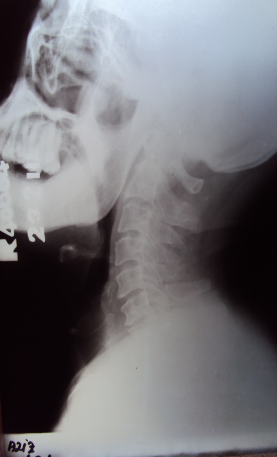 Struma Nodosa Nontoksik (SNNT) ~ Informasi Kedokteran Dan Kesehatan